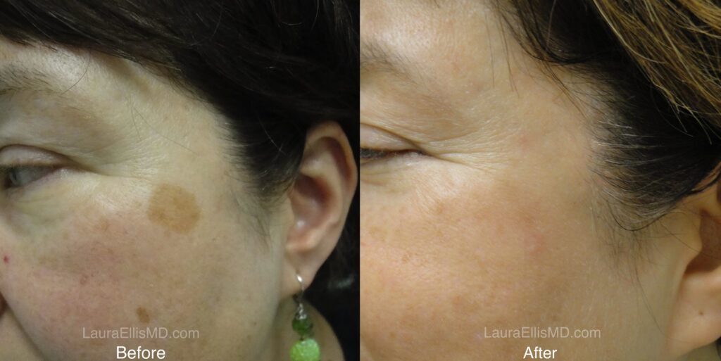 IPL - medAge Aesthetics & Wellness